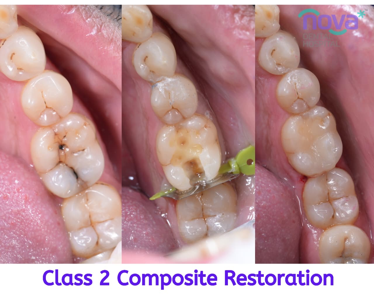 Tooth Caries Restoration in Gandhinagar | Nova Dental Hospital